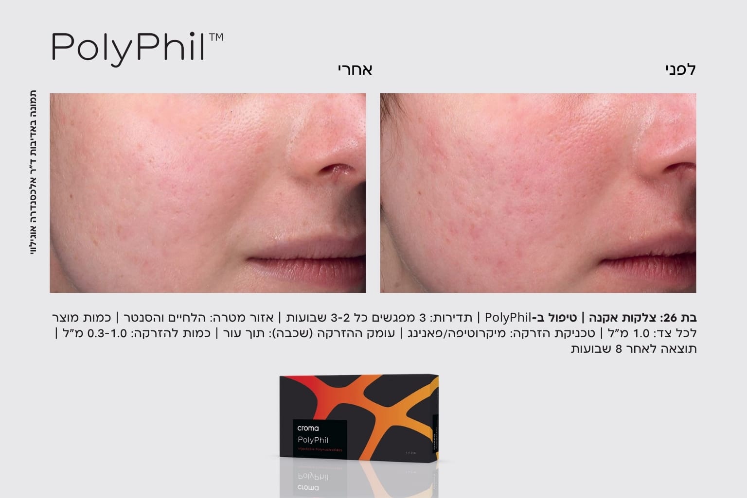 סדרת הפולינוקלאוטידים להזרקה פוליפיל PolyPhil™