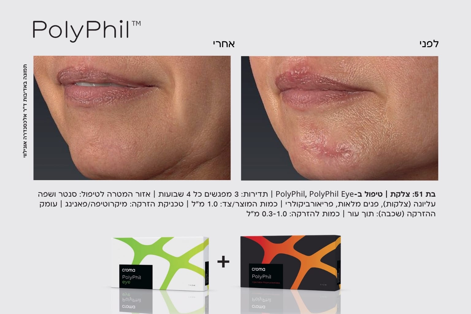 סדרת הפולינוקלאוטידים להזרקה פוליפיל PolyPhil™